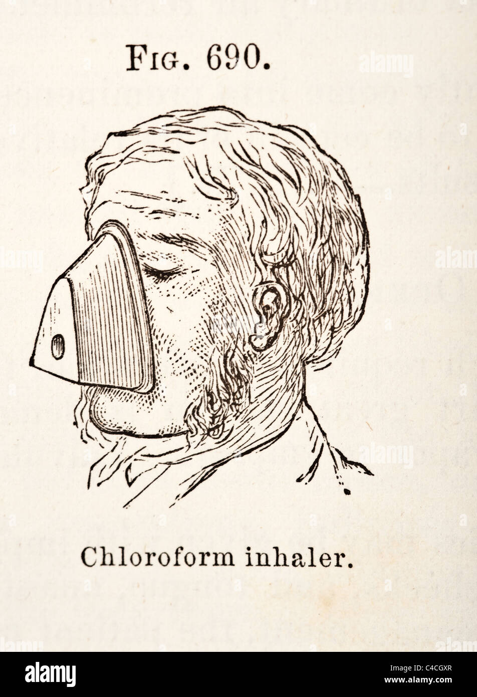 Antike medizinische Illustration der Chloroform Inhalator ca. 1881 ...