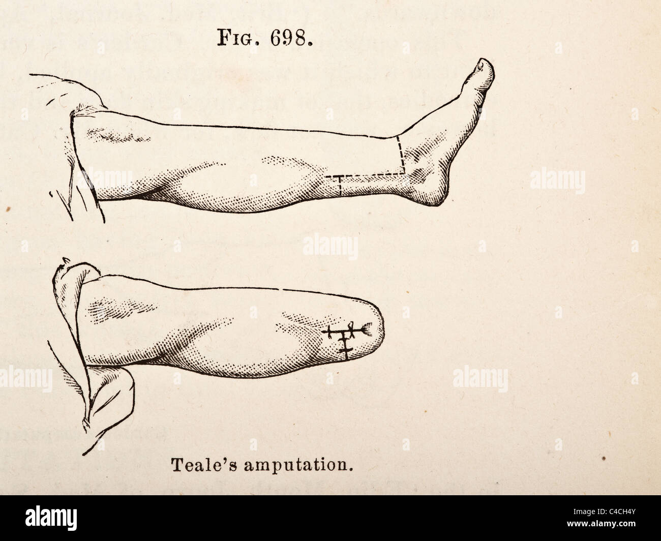 Antike medizinische Illustration des Amputation(s) Verfahrens ca. 1881 ...