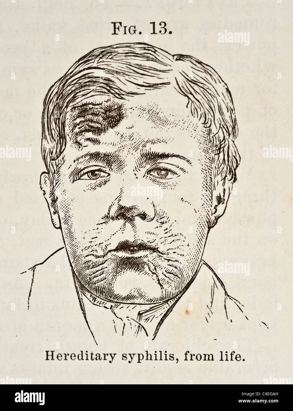 Antike medizinische Illustration der erbliche Syphilis ca. 1881 ...