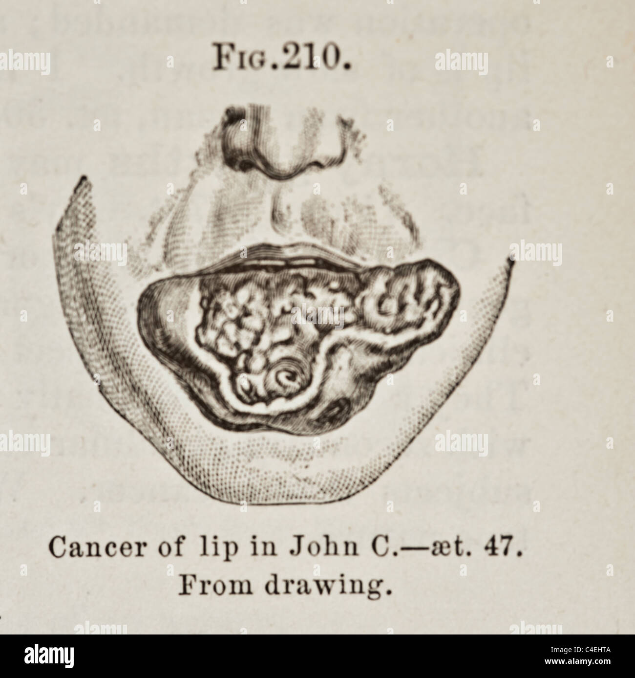 Antike medizinische Illustration der Krebs von der Lippe ca. 1881 ...