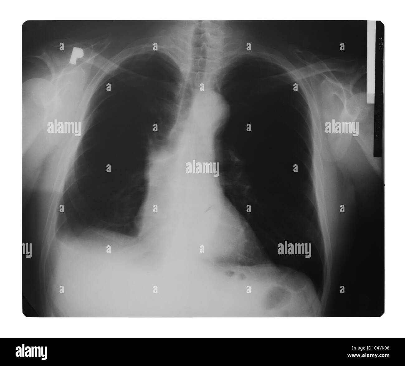 Röntgenfilm der brust Schwarzweiß-Stockfotos und -bilder - Alamy