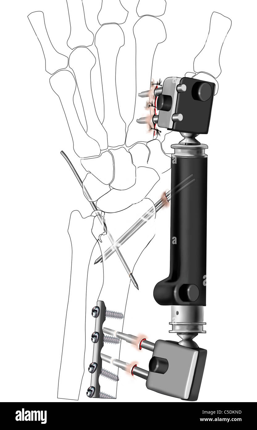 Fixateur externe hand Stockfotografie - Alamy