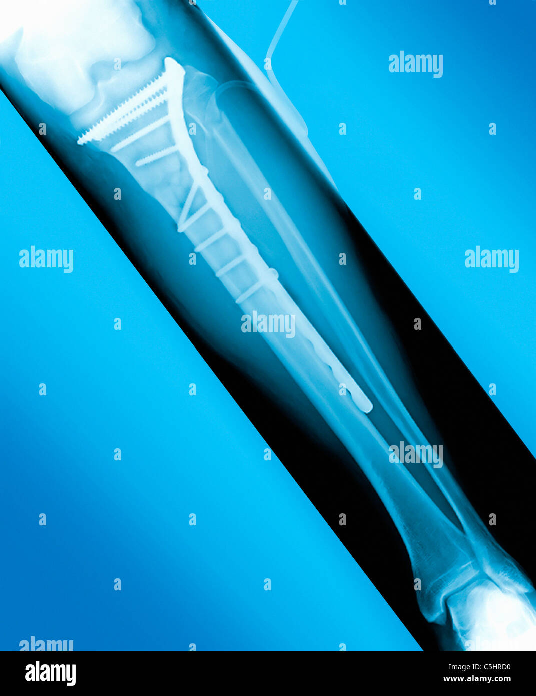 Bone fracture repair -Fotos und -Bildmaterial in hoher Auflösung – Alamy