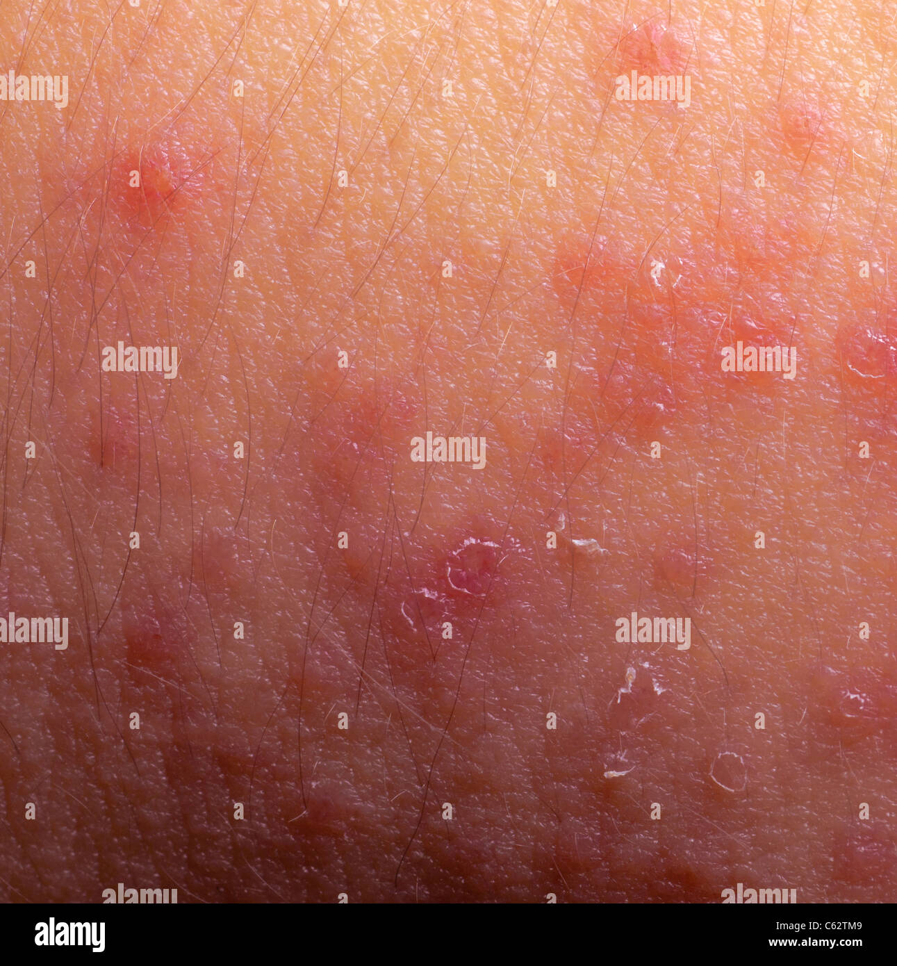 Ekzeme Neurodermitis Symptom Hautstruktur detail Stockfotografie - Alamy