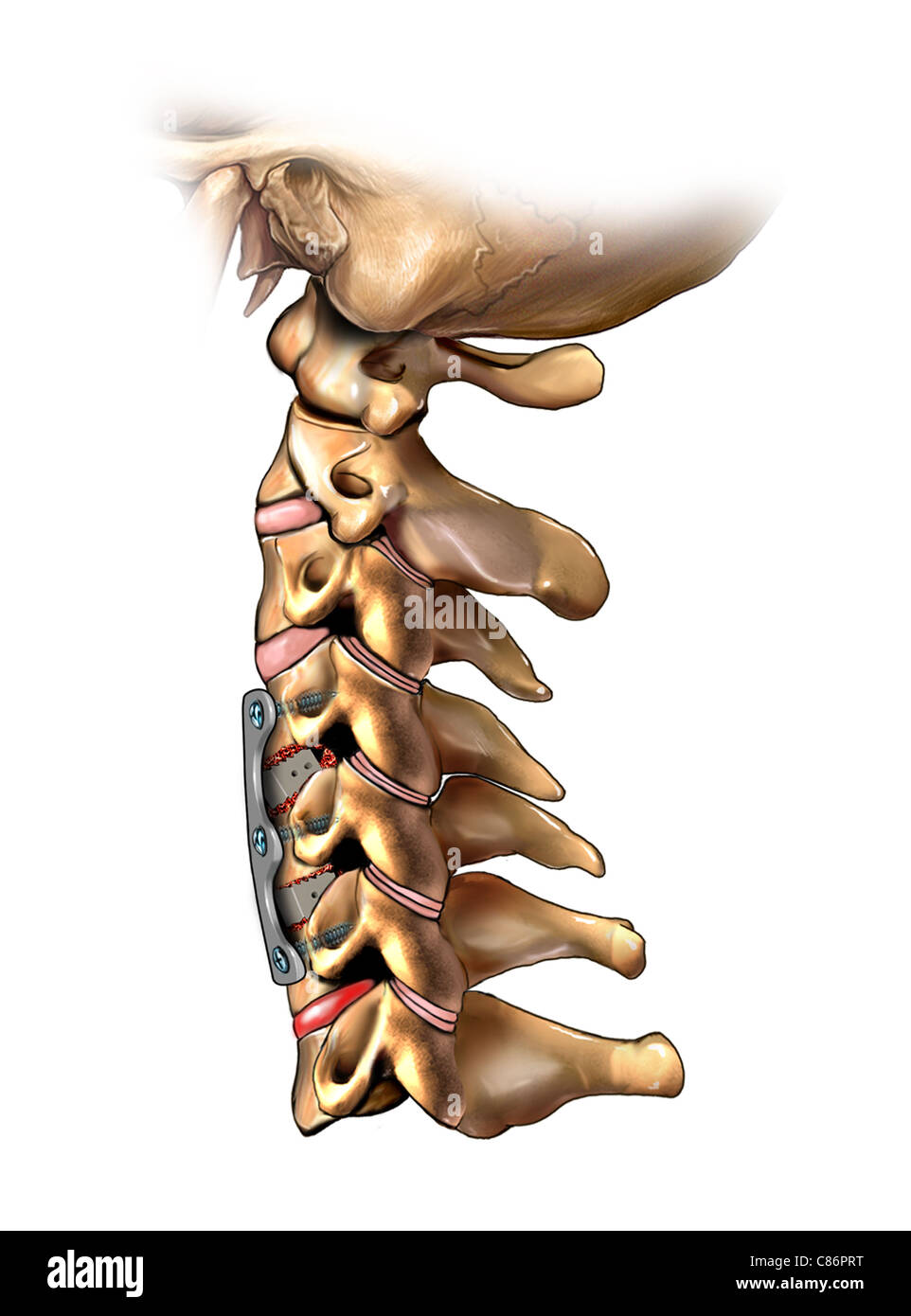Cervical bone fusion -Fotos und -Bildmaterial in hoher Auflösung – Alamy