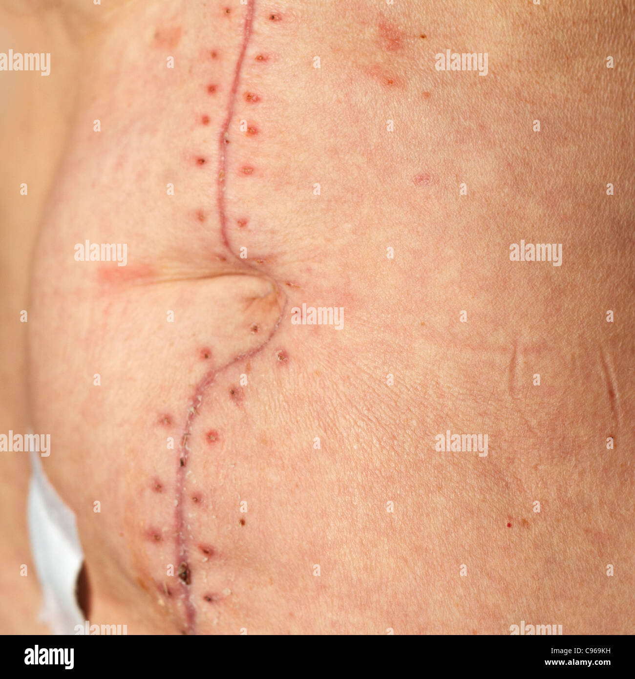 Incision scar -Fotos und -Bildmaterial in hoher Auflösung – Alamy