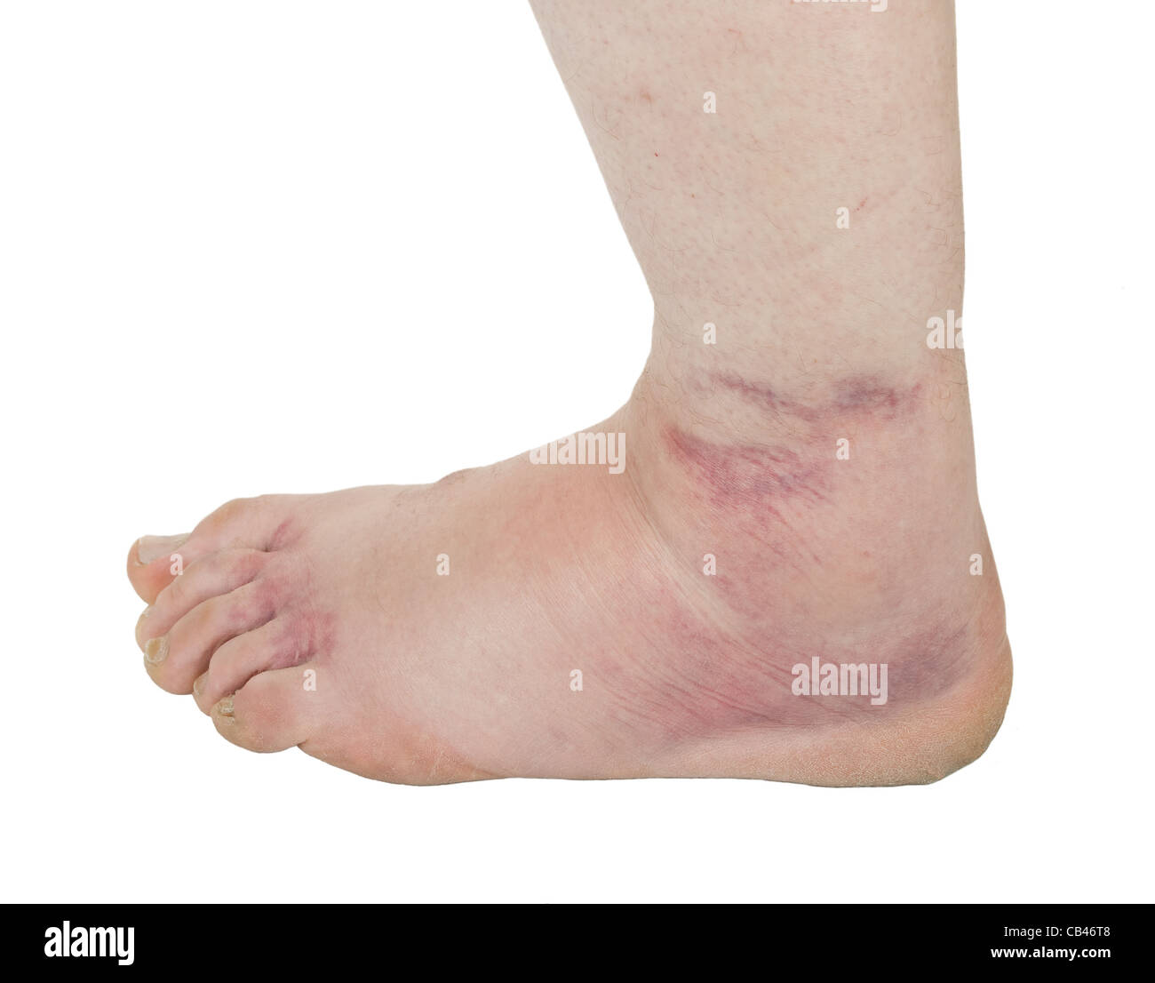 Verstauchter knöchel -Fotos und -Bildmaterial in hoher Auflösung – Alamy