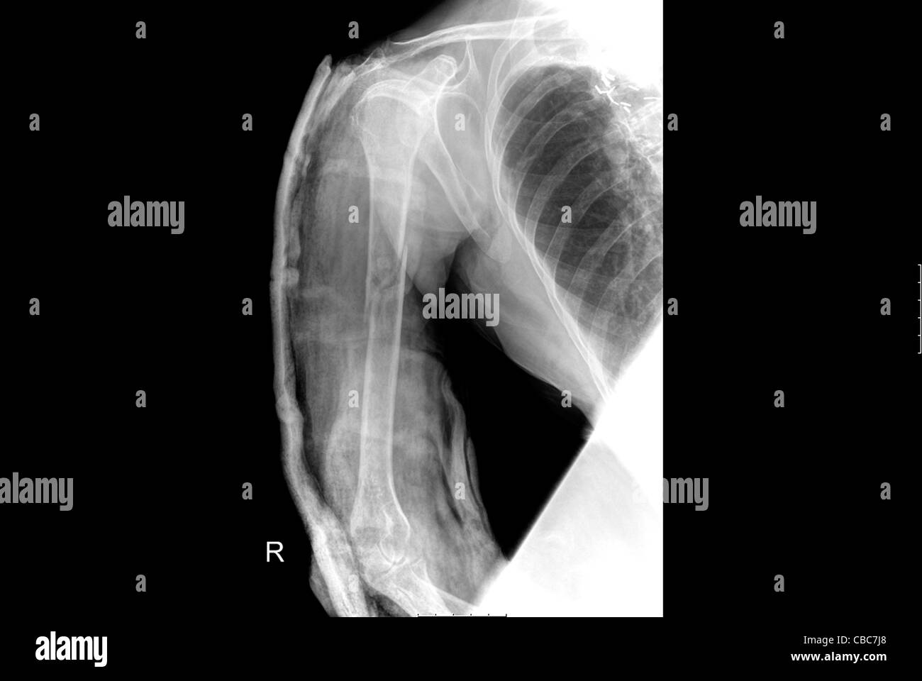 Schulter und arm Röntgen eine 80 Jahre alte Patientin mit einem ...