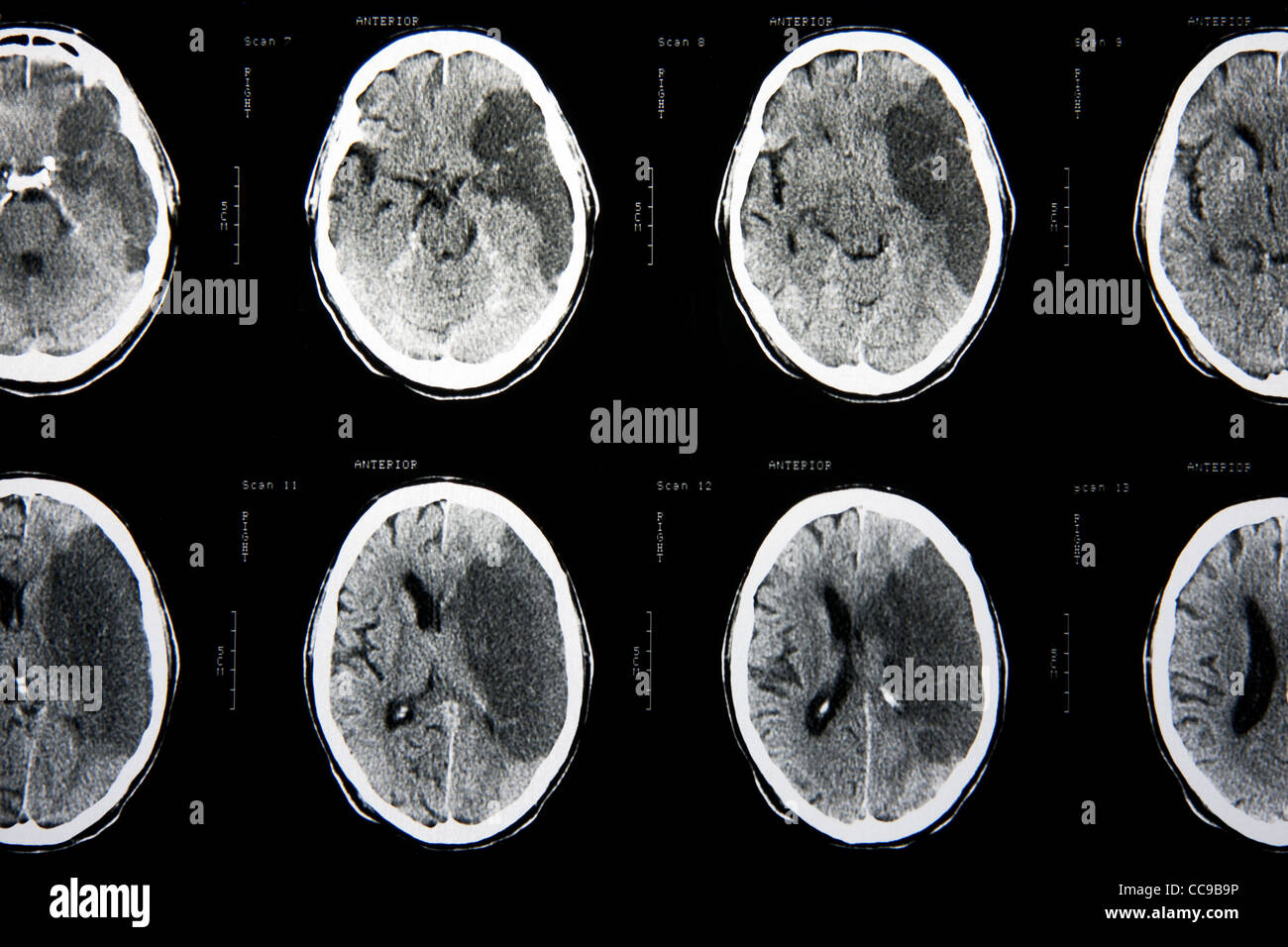 Ct des gehirns -Fotos und -Bildmaterial in hoher Auflösung – Alamy