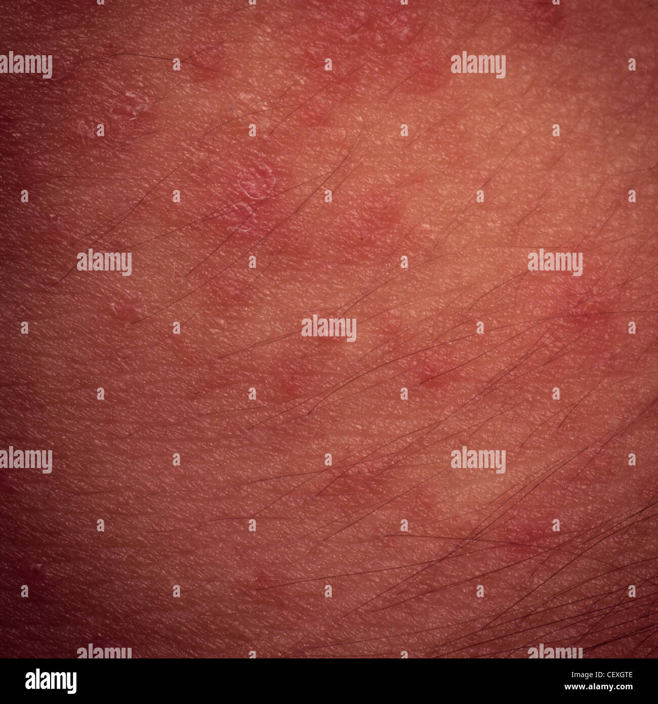 Atopische dermatitis -Fotos und -Bildmaterial in hoher Auflösung – Alamy