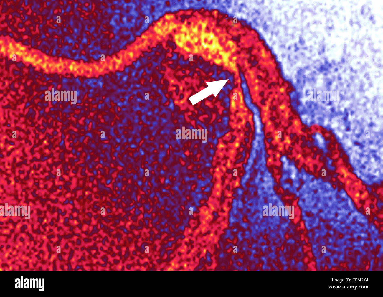 Myocardium infarct -Fotos und -Bildmaterial in hoher Auflösung – Alamy