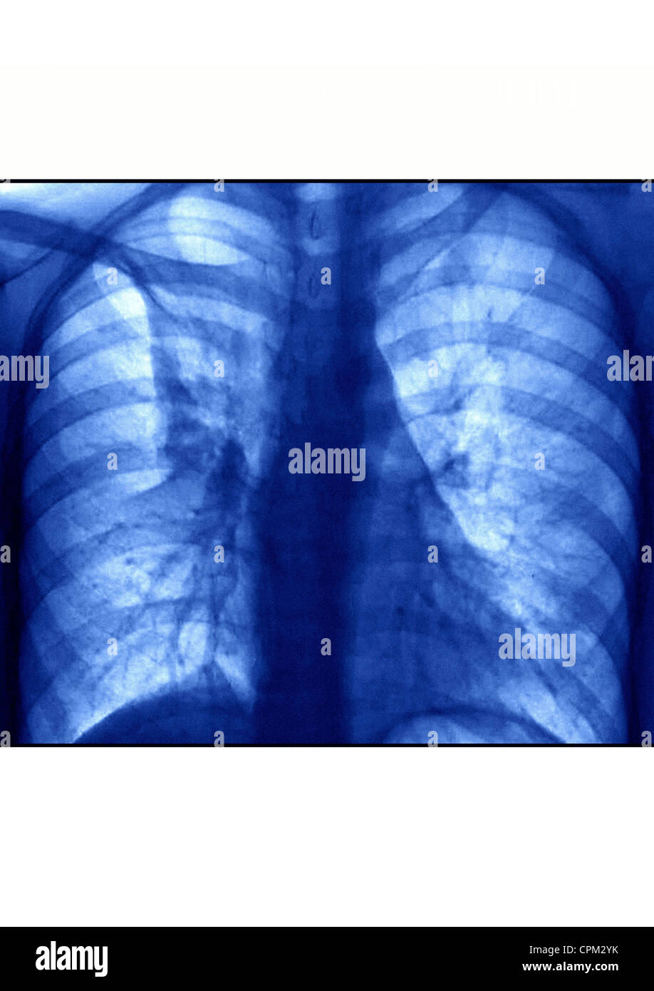 Bronchitis radiography -Fotos und -Bildmaterial in hoher Auflösung – Alamy