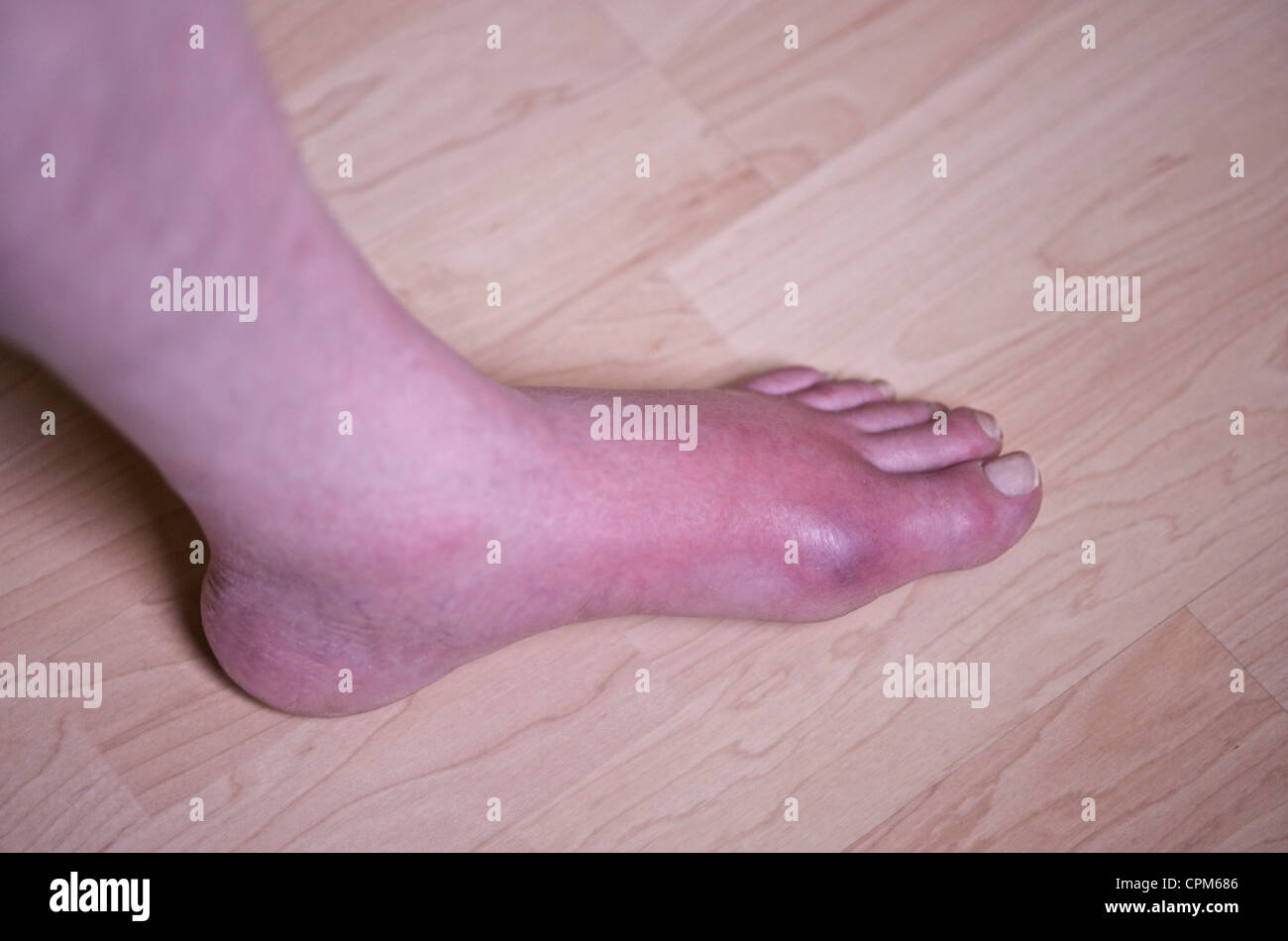 Gicht tophus -Fotos und -Bildmaterial in hoher Auflösung – Alamy