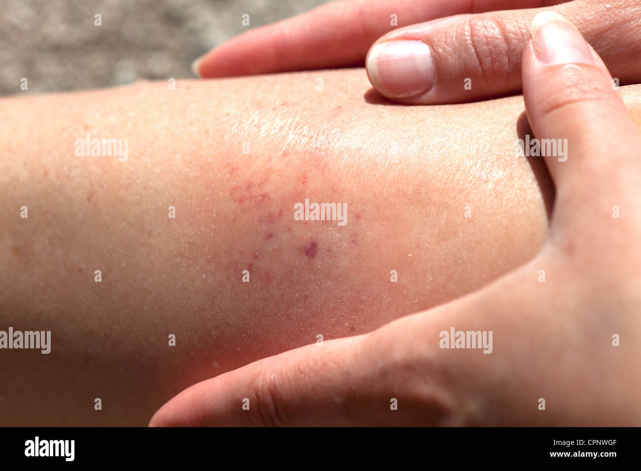 Hämatom hand -Fotos und -Bildmaterial in hoher Auflösung – Alamy