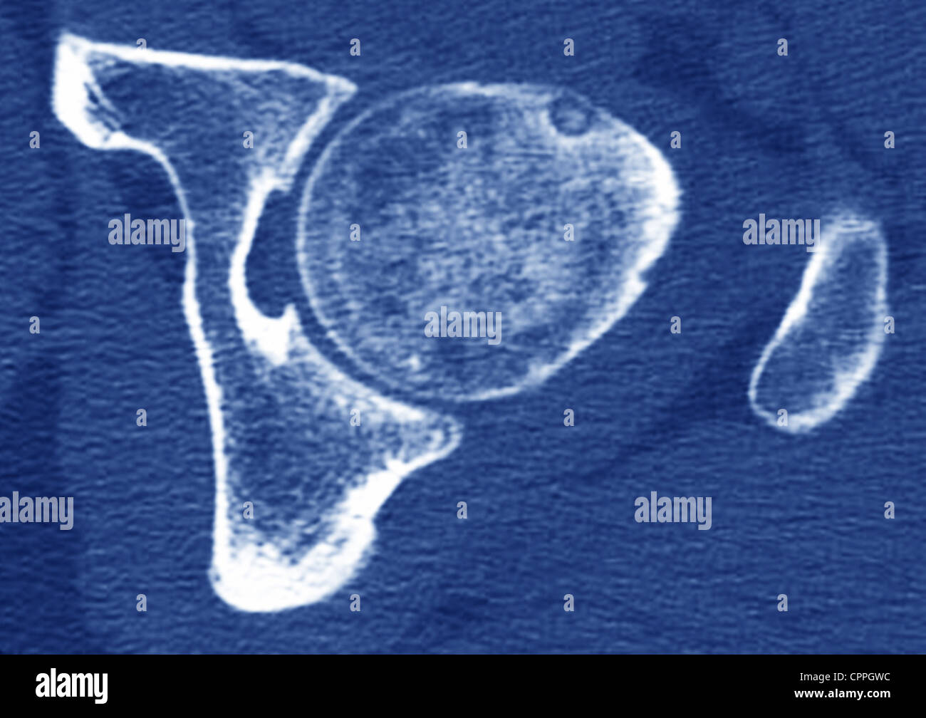 Osteoid osteom -Fotos und -Bildmaterial in hoher Auflösung – Alamy