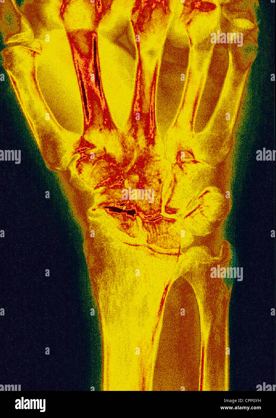 Osteoarthritis am handgelenk -Fotos und -Bildmaterial in hoher ...