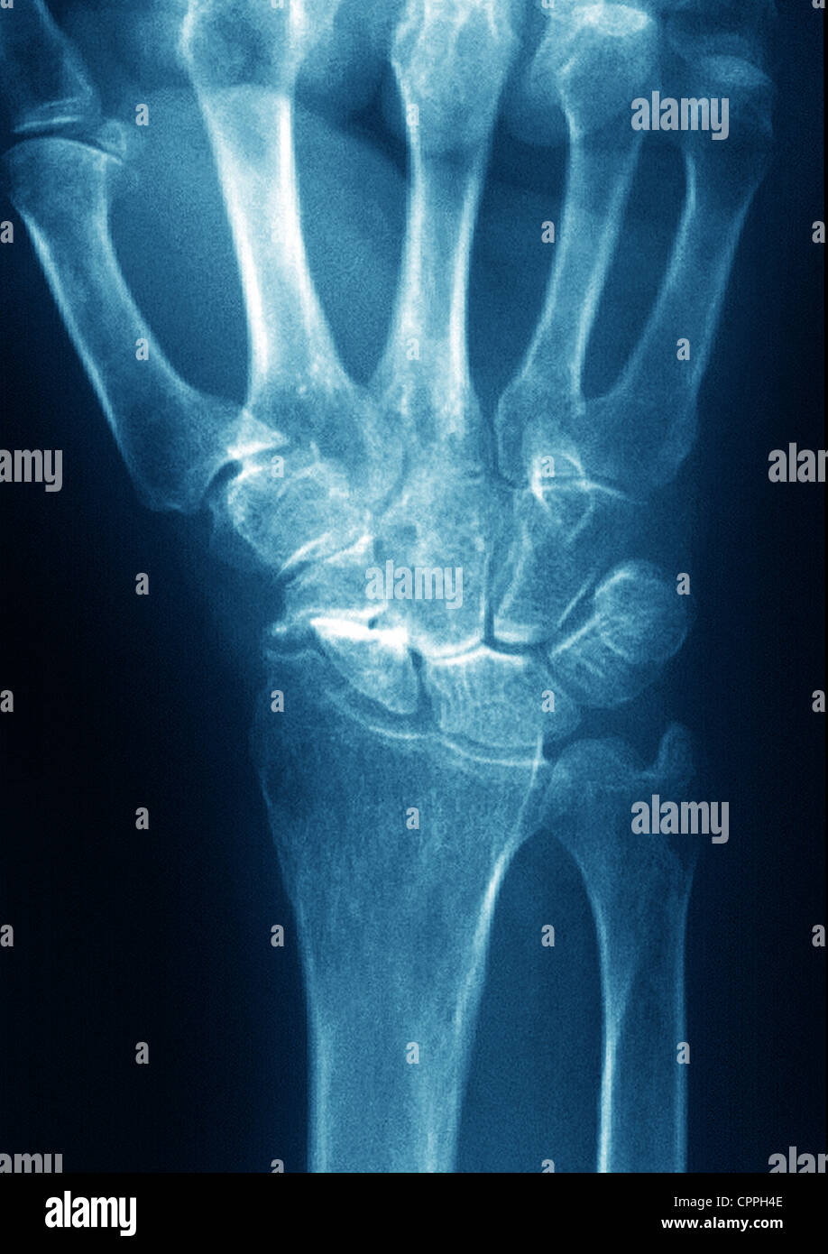 Osteoarthritis am handgelenk -Fotos und -Bildmaterial in hoher ...