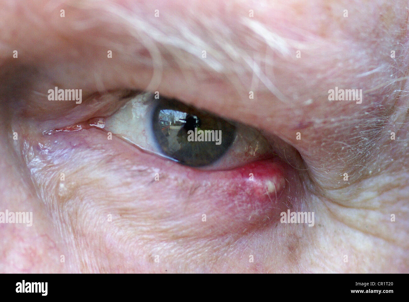 Stye infection -Fotos und -Bildmaterial in hoher Auflösung – Alamy