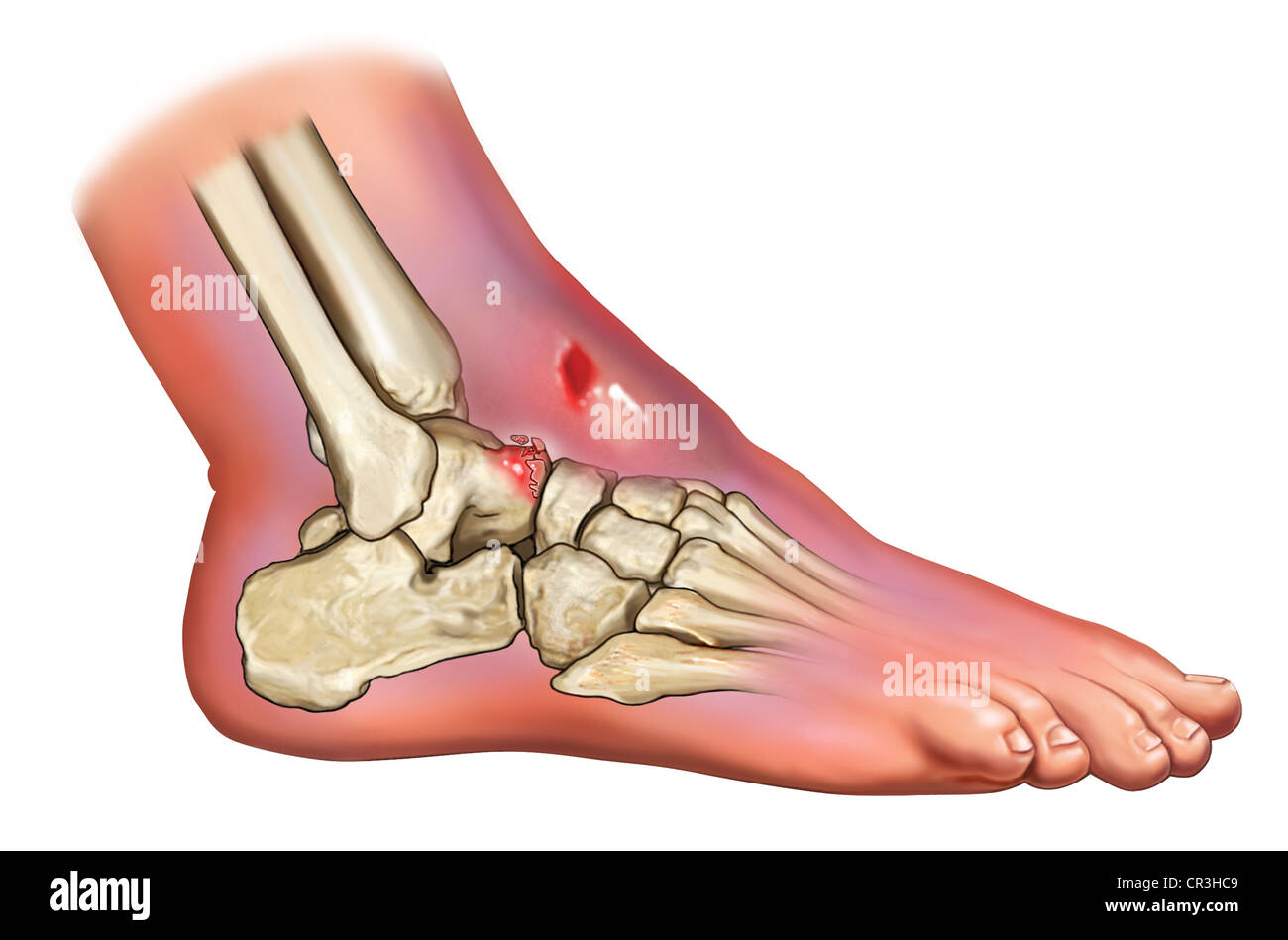 Swollen feet -Fotos und -Bildmaterial in hoher Auflösung – Alamy