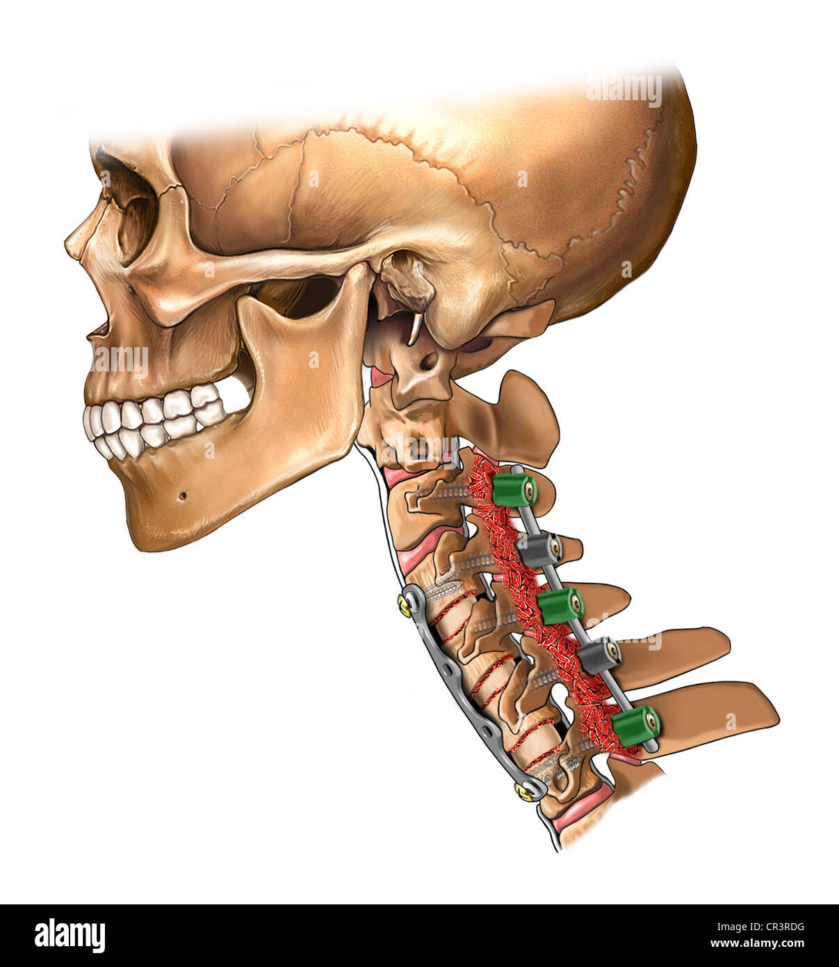 Cervical bone fusion -Fotos und -Bildmaterial in hoher Auflösung – Alamy
