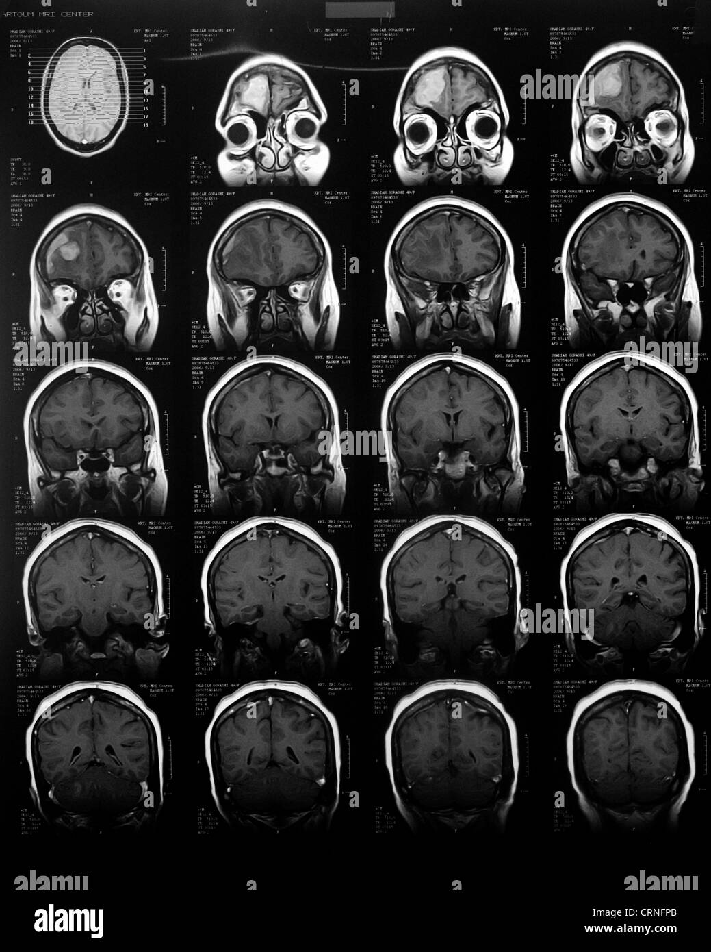MRT-Untersuchung von Personen Schädel und Gehirn Stockfotografie - Alamy