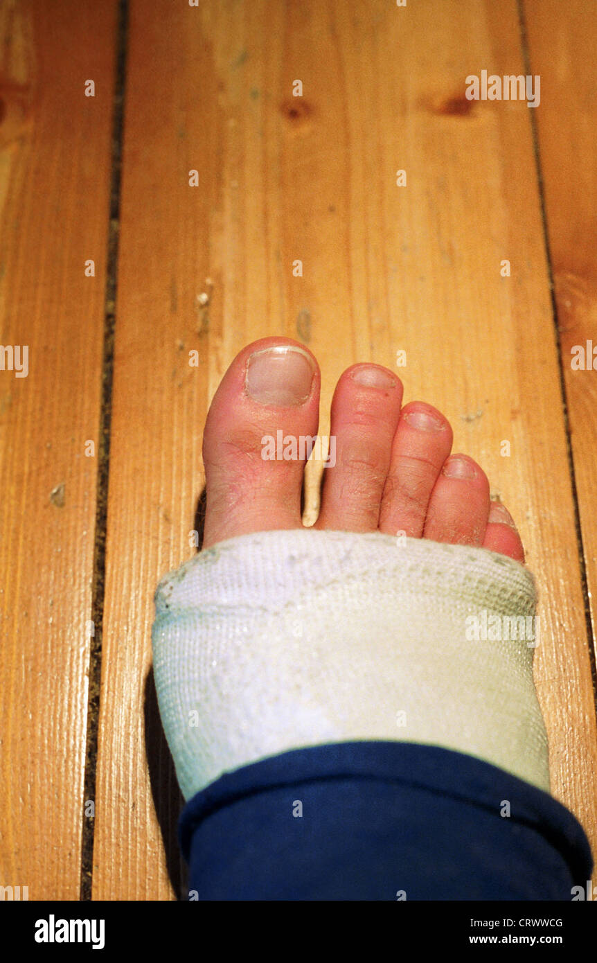 Plaster foot -Fotos und -Bildmaterial in hoher Auflösung – Alamy