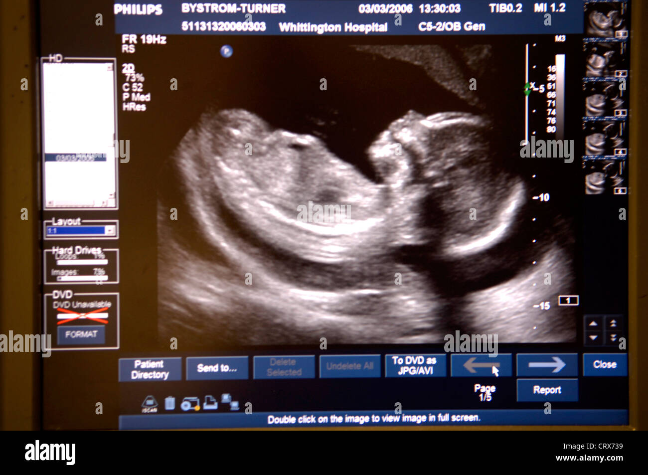 Ultraschallbild embryo -Fotos und -Bildmaterial in hoher Auflösung – Alamy