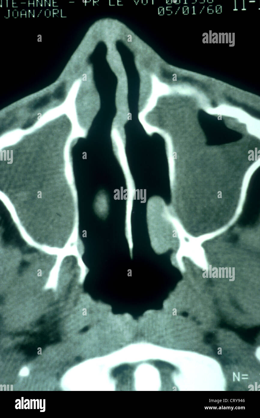 Maxillary Sinuses Stockfotos & Maxillary Sinuses Bilder - Alamy