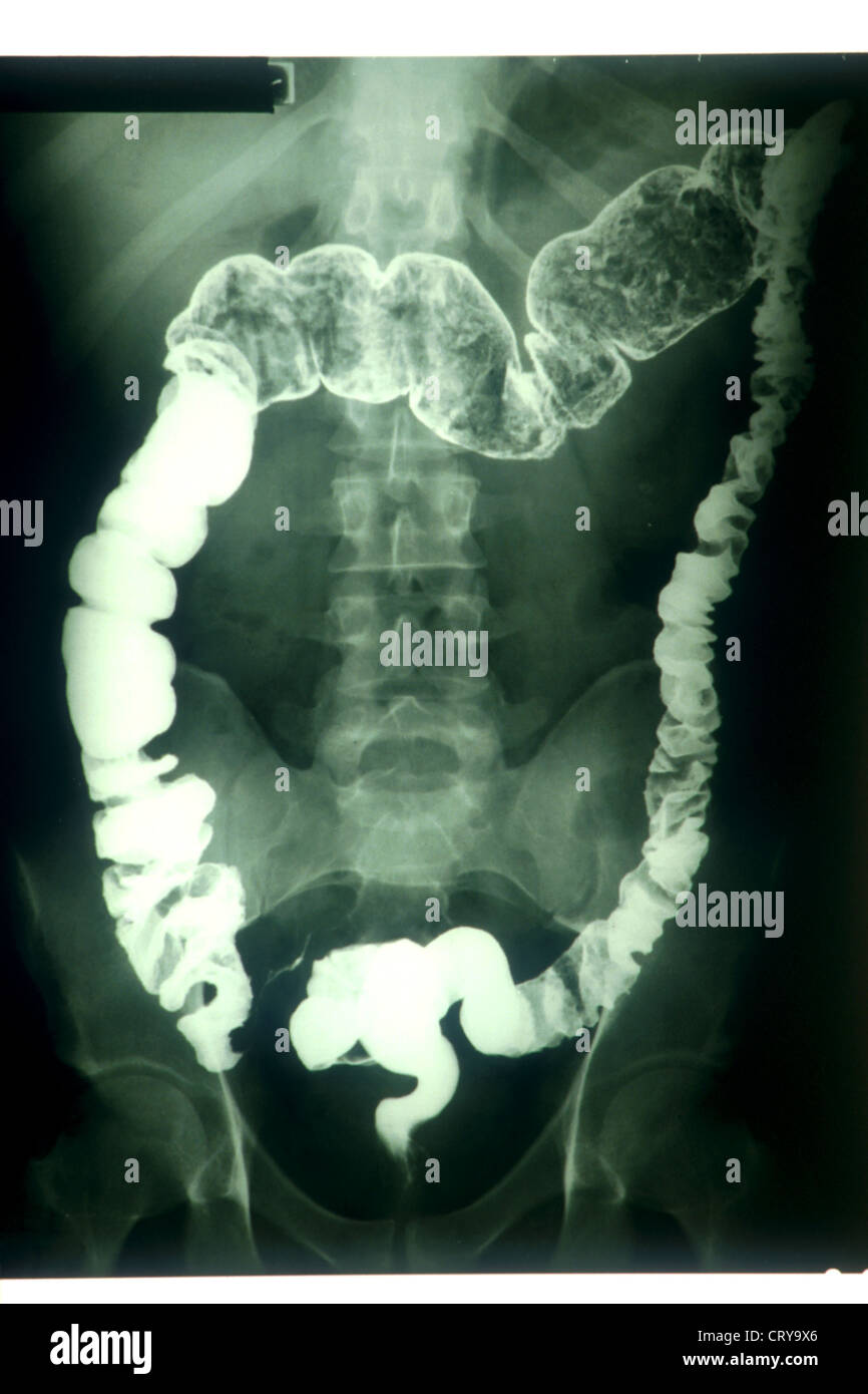 COLITIS ULCEROSA, X-RAY Stockfotografie - Alamy