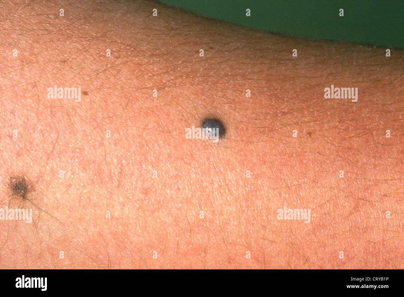 Angiom tumor -Fotos und -Bildmaterial in hoher Auflösung – Alamy