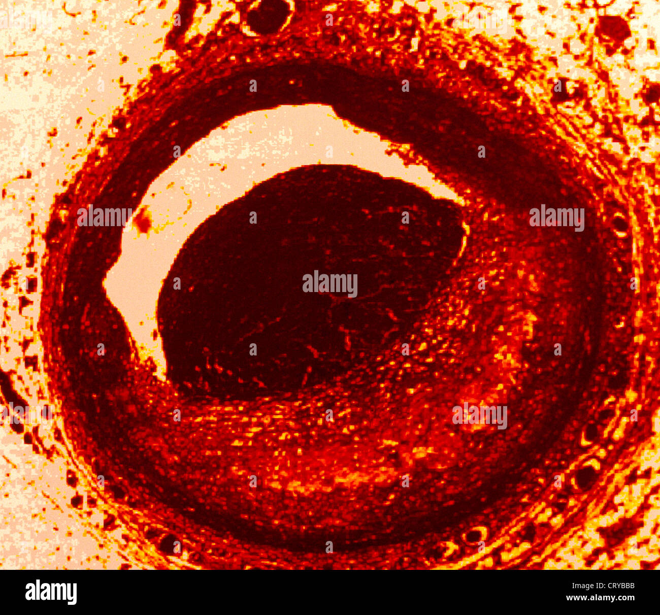 Hemorragias arteriales -Fotos und -Bildmaterial in hoher Auflösung – Alamy