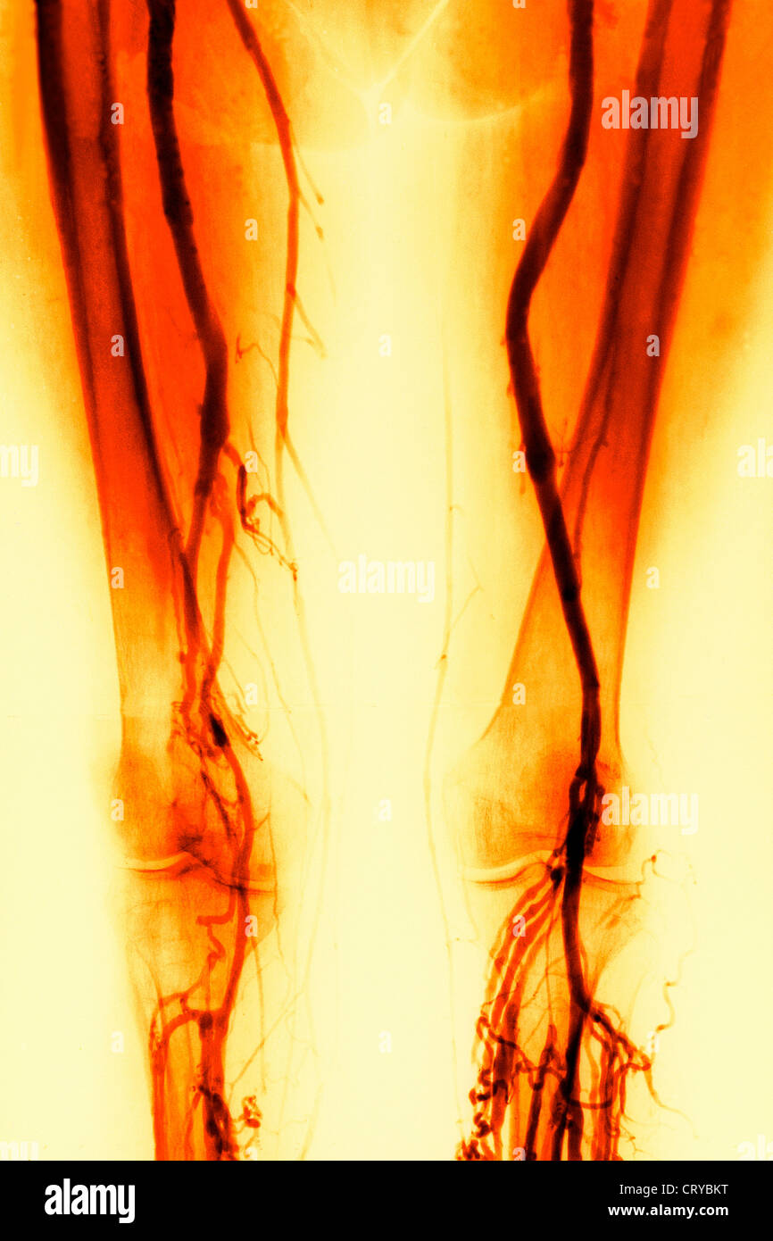 Femoral vein -Fotos und -Bildmaterial in hoher Auflösung – Alamy