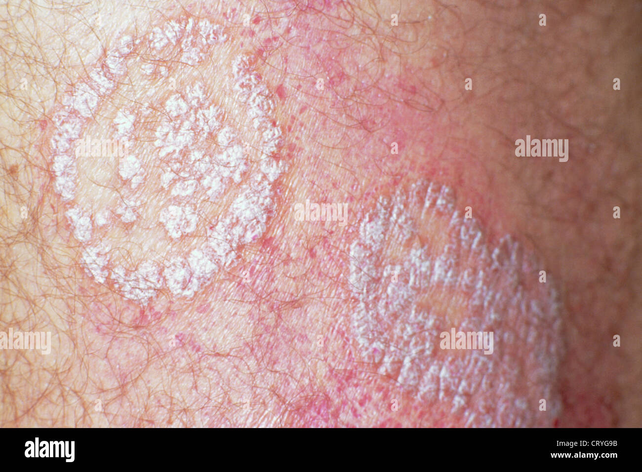 Psoriasi cutanea -Fotos und -Bildmaterial in hoher Auflösung – Alamy