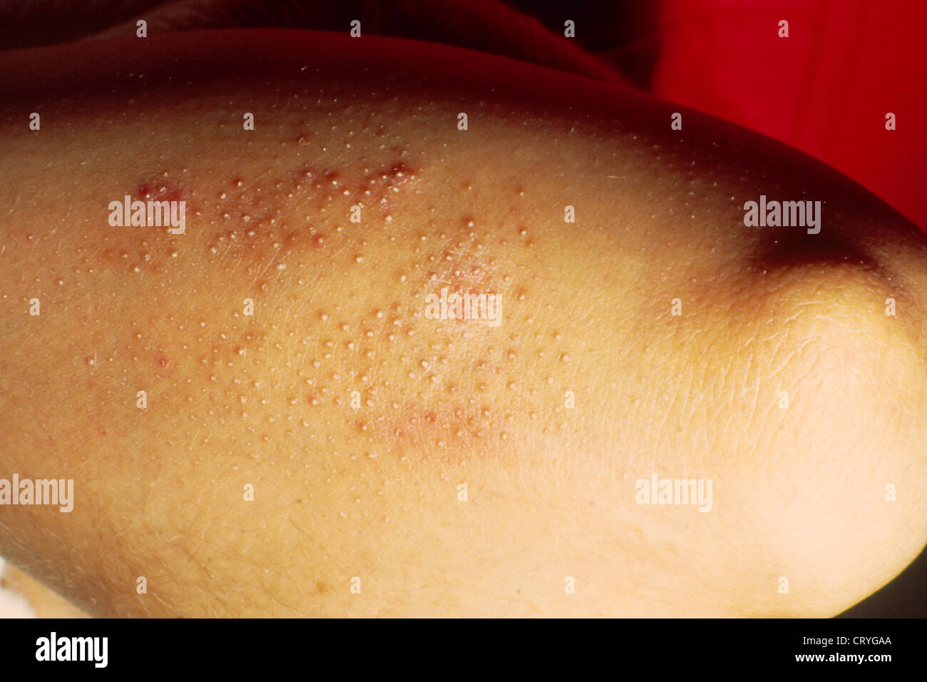 Pityriasis rubra pilaris -Fotos und -Bildmaterial in hoher Auflösung ...