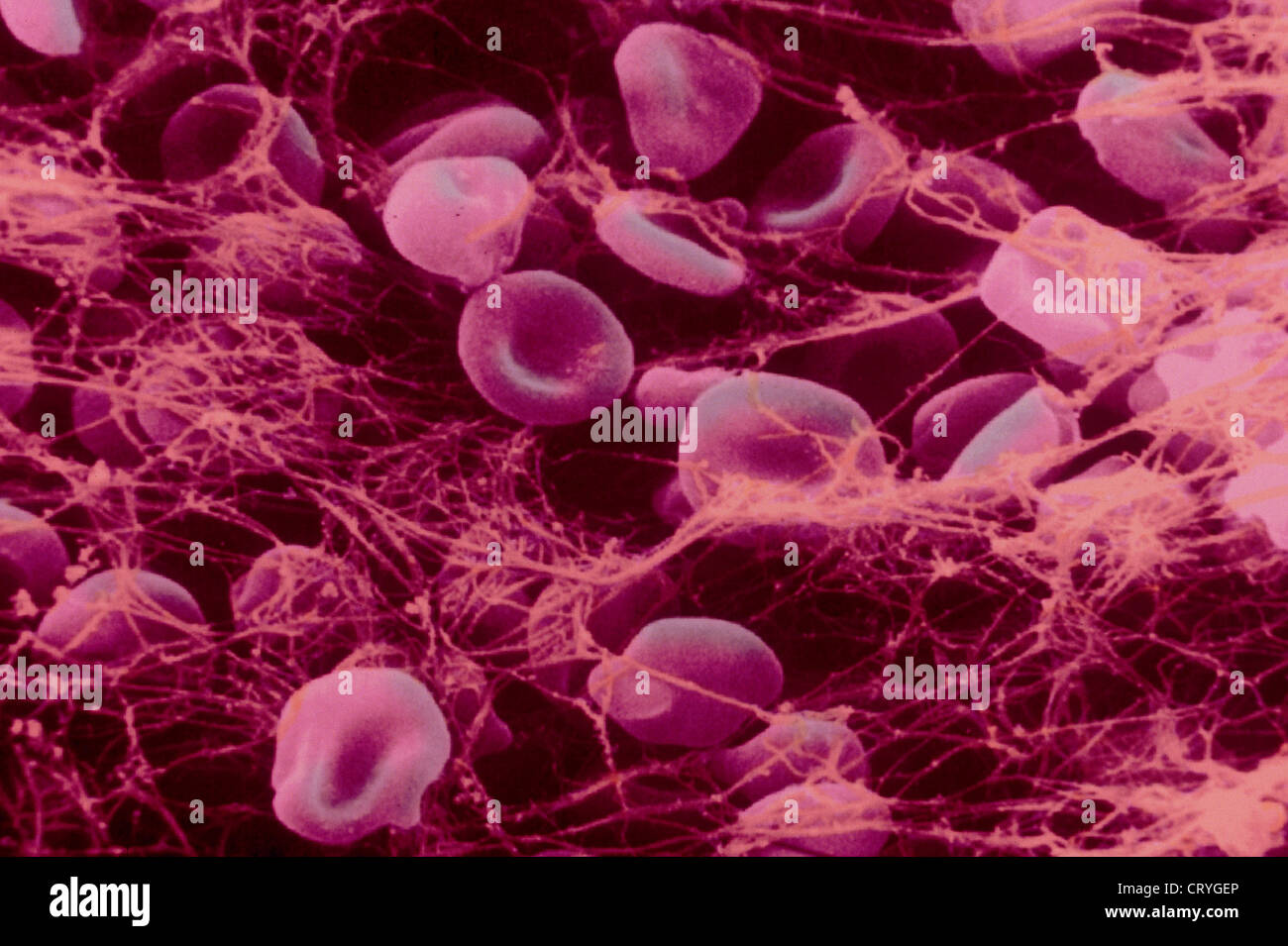 Koagulum fibrin -Fotos und -Bildmaterial in hoher Auflösung – Alamy
