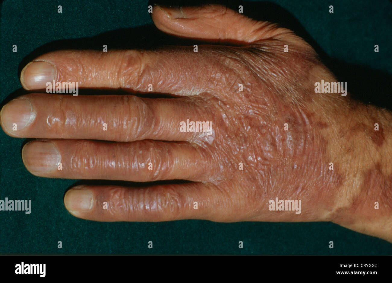 Kaposi sarkom -Fotos und -Bildmaterial in hoher Auflösung – Alamy