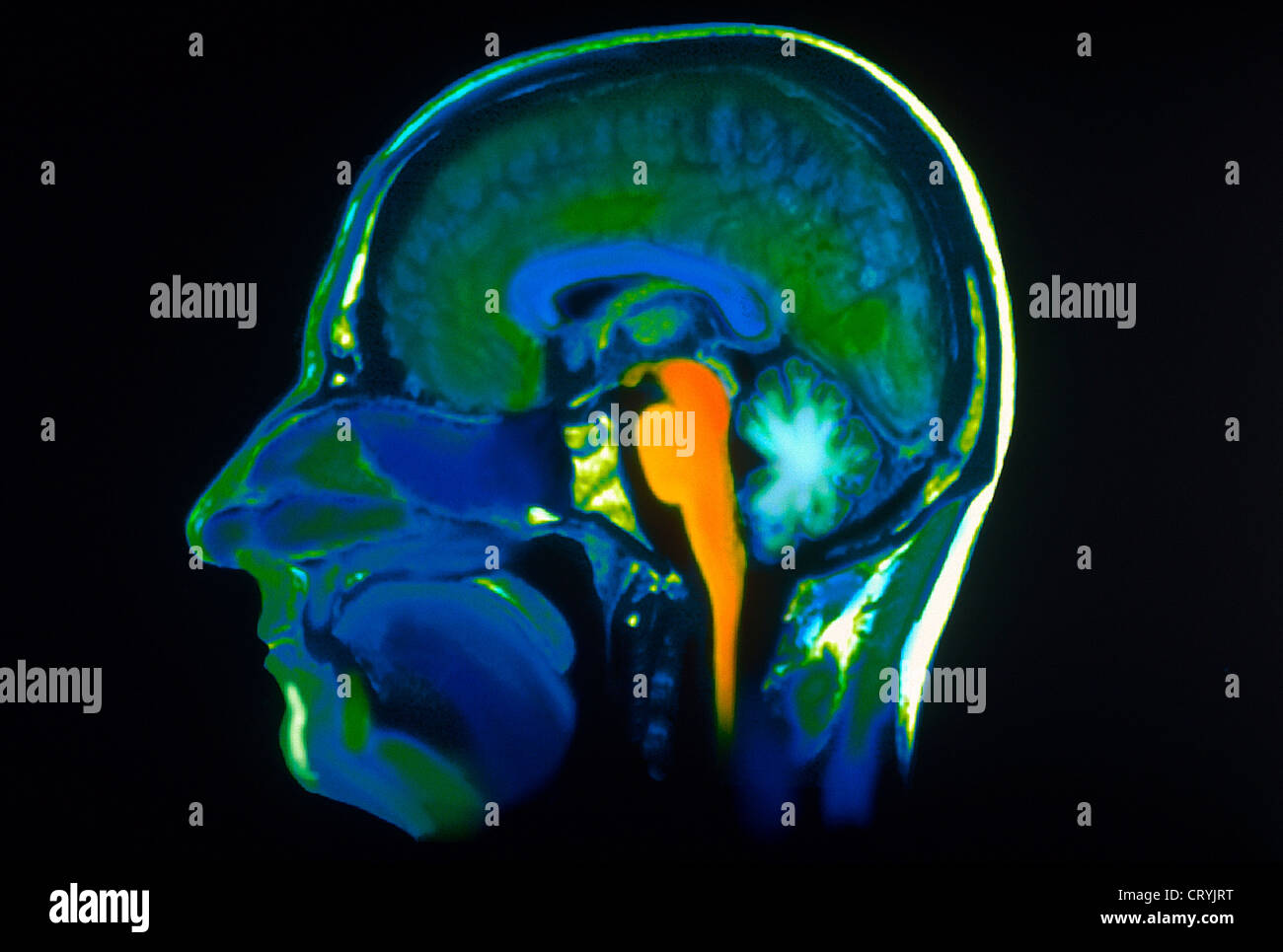 Mri scan des normalen gehirns -Fotos und -Bildmaterial in hoher Auflösung – Alamy