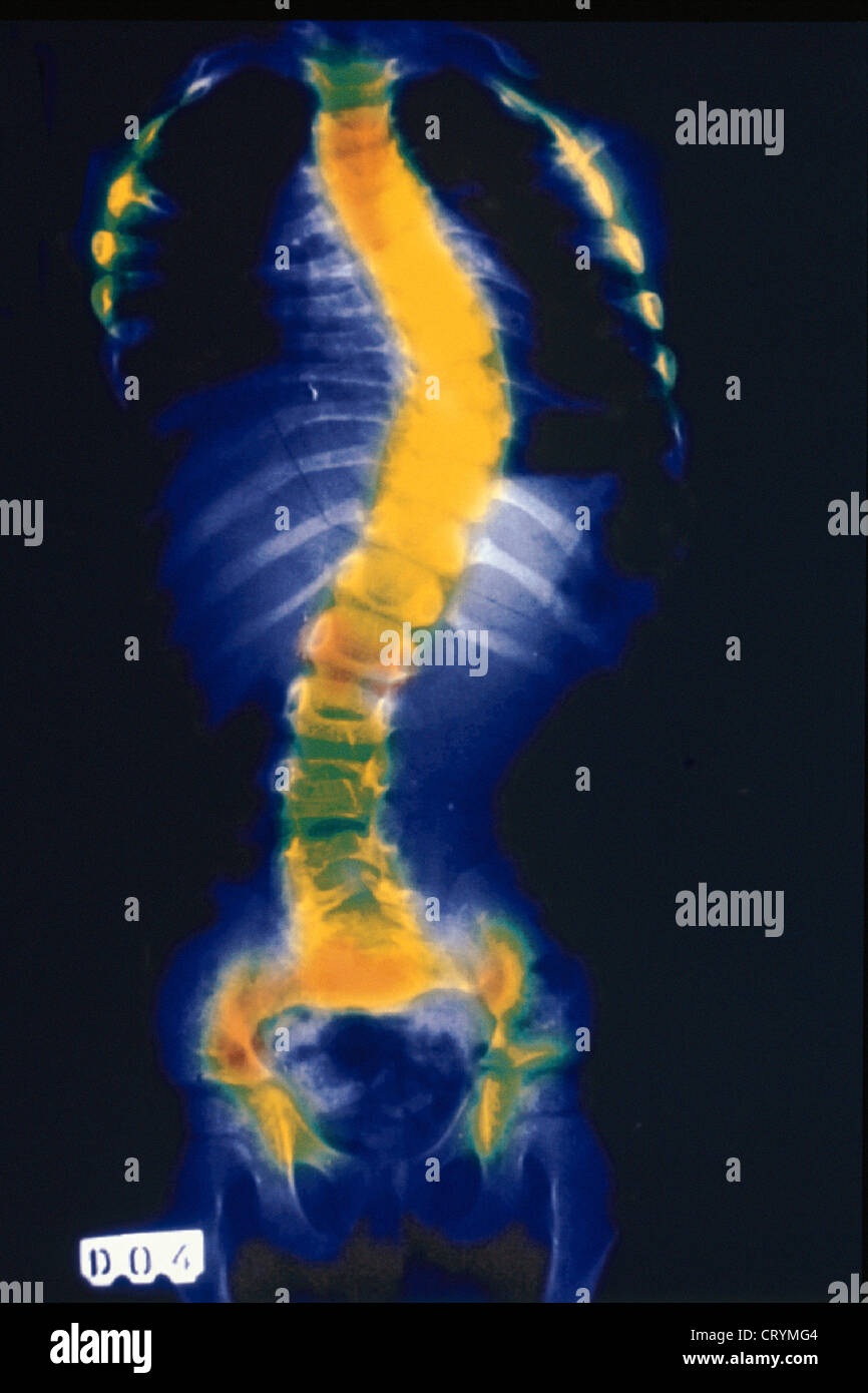 Rickets x ray -Fotos und -Bildmaterial in hoher Auflösung – Alamy