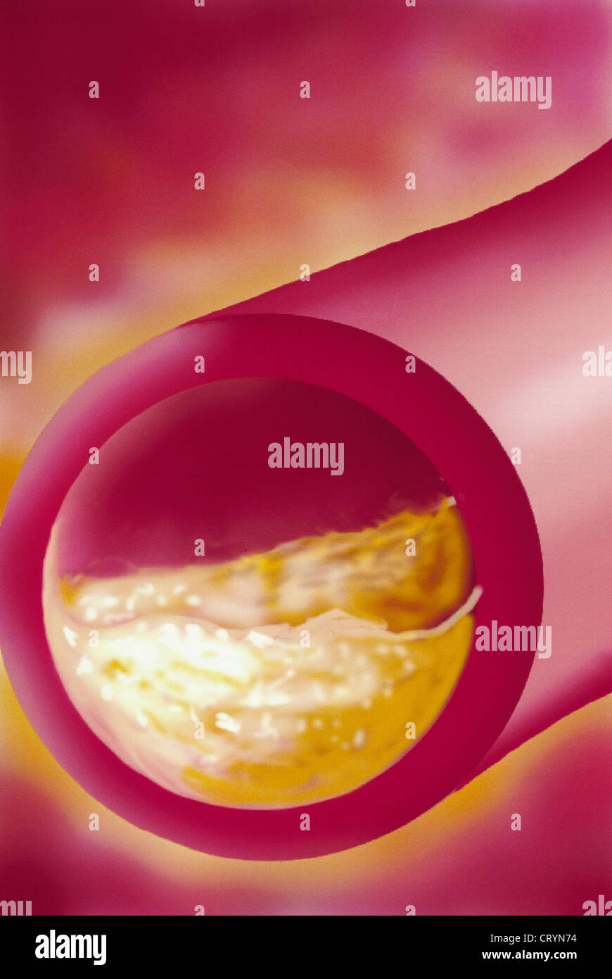 Cholesterin atherom -Fotos und -Bildmaterial in hoher Auflösung – Alamy