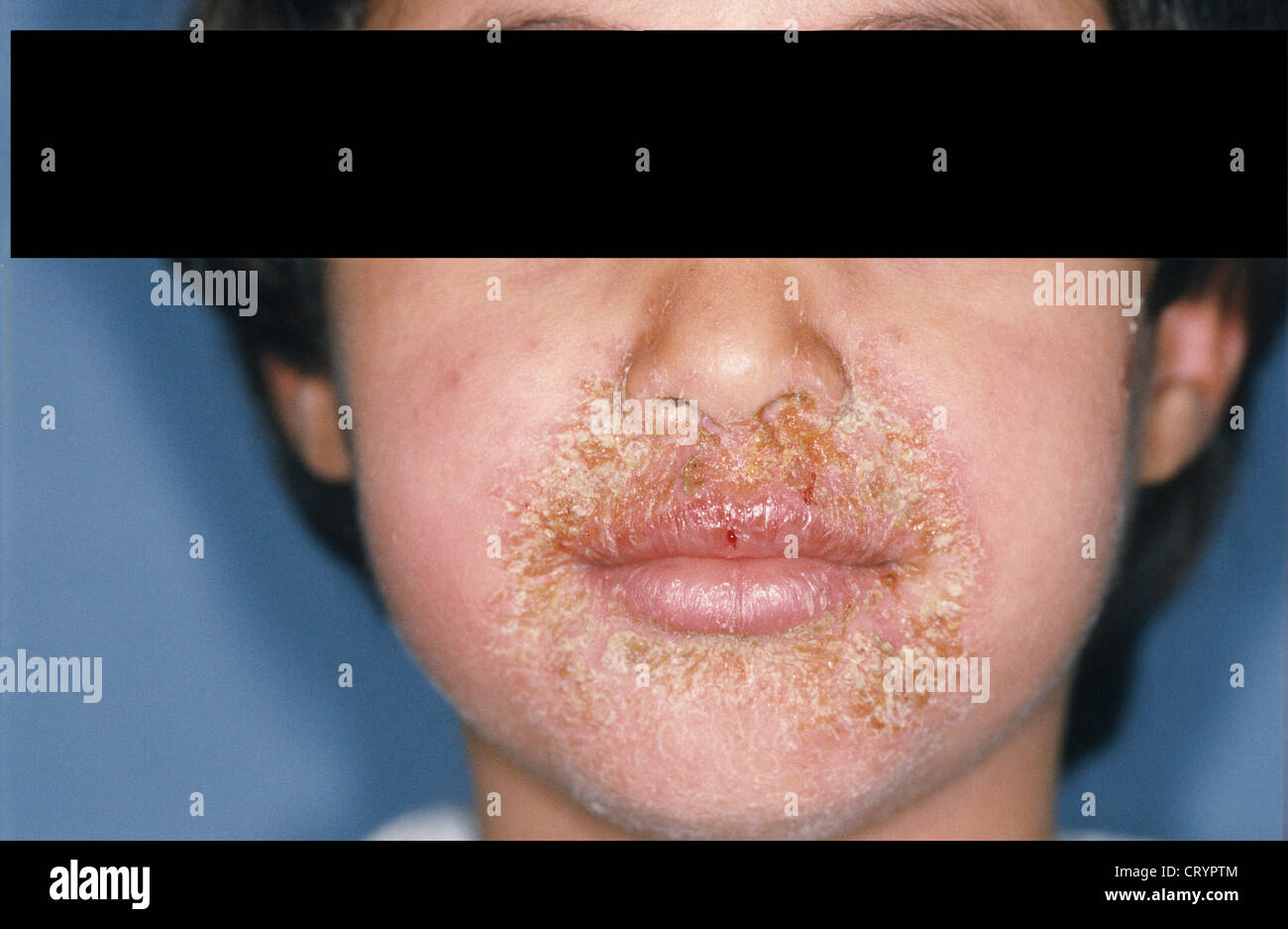 Pyoderma -Fotos und -Bildmaterial in hoher Auflösung – Alamy