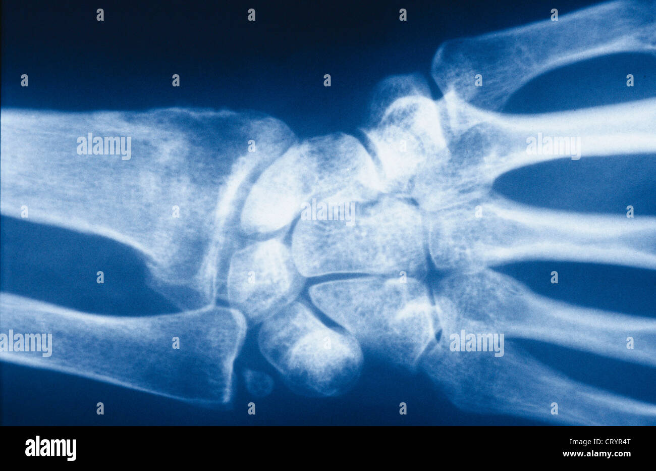 Handgelenk malunion -Fotos und -Bildmaterial in hoher Auflösung – Alamy