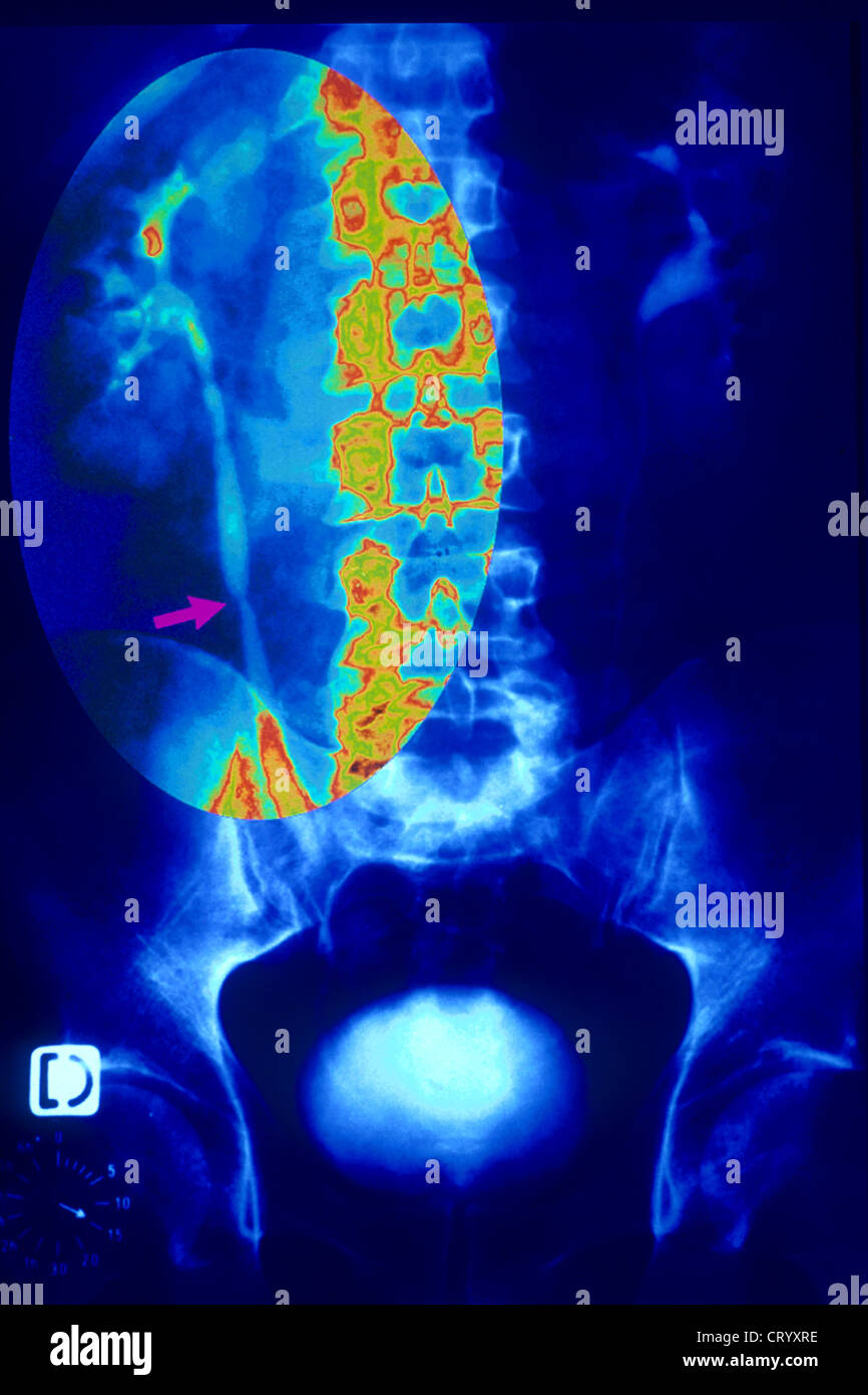 Ureteral lithiasis -Fotos und -Bildmaterial in hoher Auflösung – Alamy