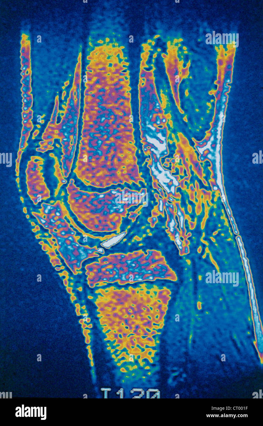 Mri des meniskus -Fotos und -Bildmaterial in hoher Auflösung – Alamy