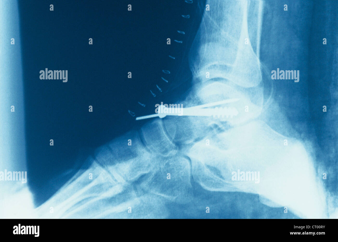KNÖCHEL OSTEOSYNTHESE, X-RAY Stockfotografie - Alamy