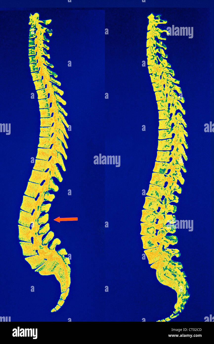 Columna vertebral deformada -Fotos und -Bildmaterial in hoher Auflösung ...