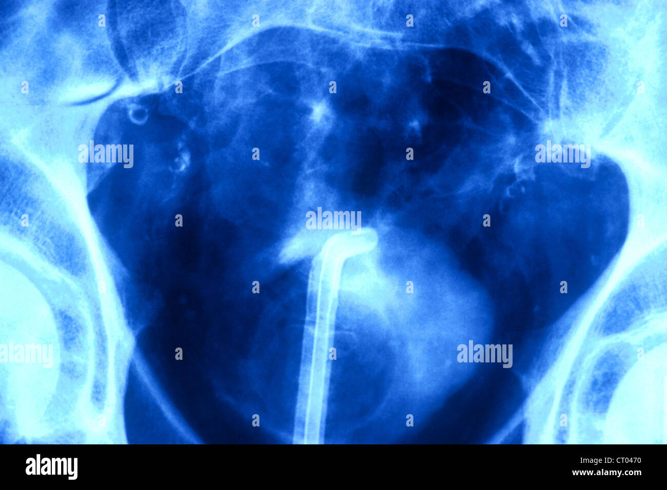 Katheter in harnblase -Fotos und -Bildmaterial in hoher Auflösung – Alamy