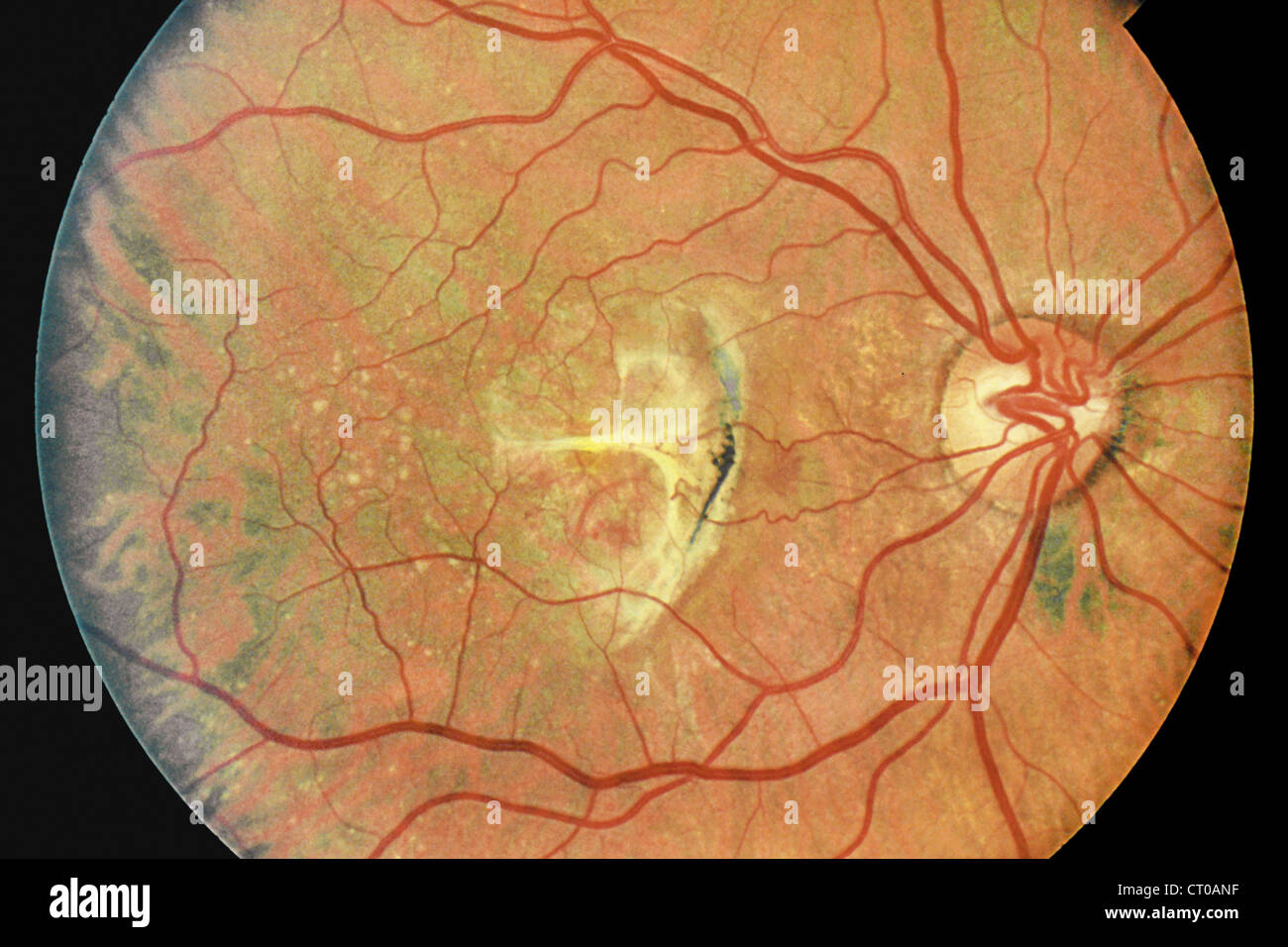 Degeneration der macula lutea -Fotos und -Bildmaterial in hoher ...
