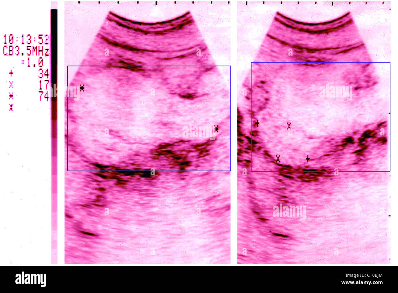 Normal Uterus Stockfotos und -bilder Kaufen - Alamy