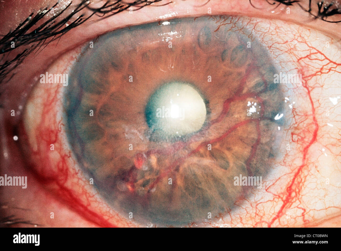 Rubeose glaukom -Fotos und -Bildmaterial in hoher Auflösung – Alamy