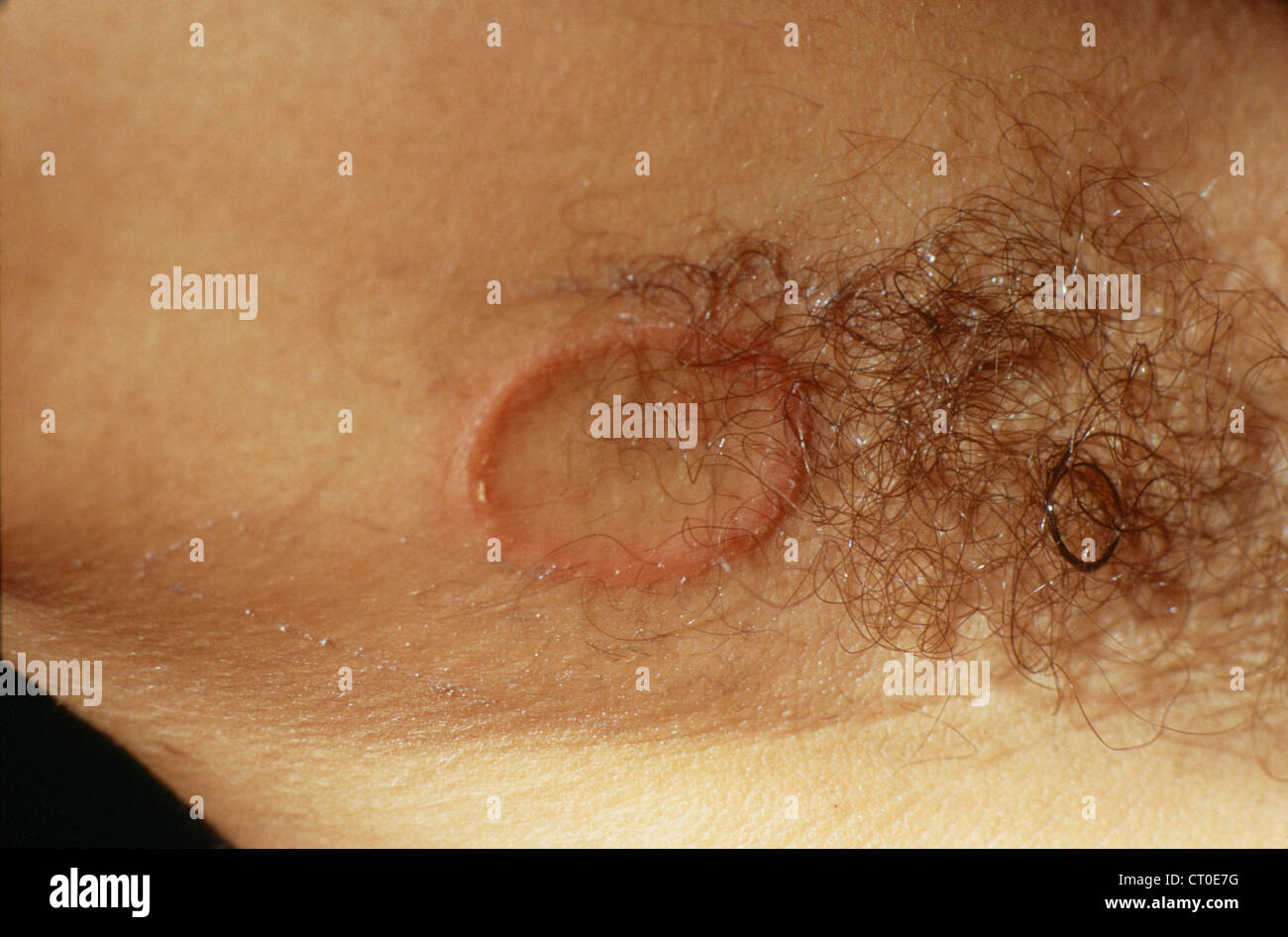 Dermatophyte fungus -Fotos und -Bildmaterial in hoher Auflösung – Alamy